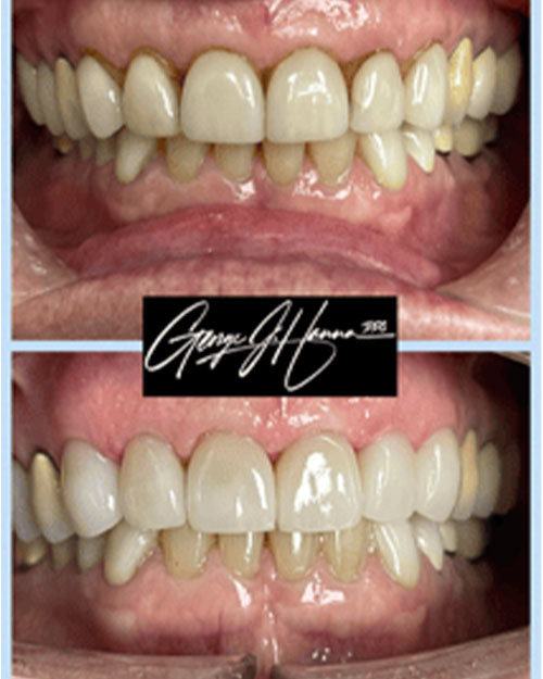Crowns in Pasadena, CA | Pasadena Advanced Dentistry